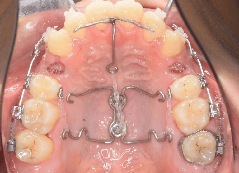 Anchor Lock System - 株式会社ジーシーオルソリー